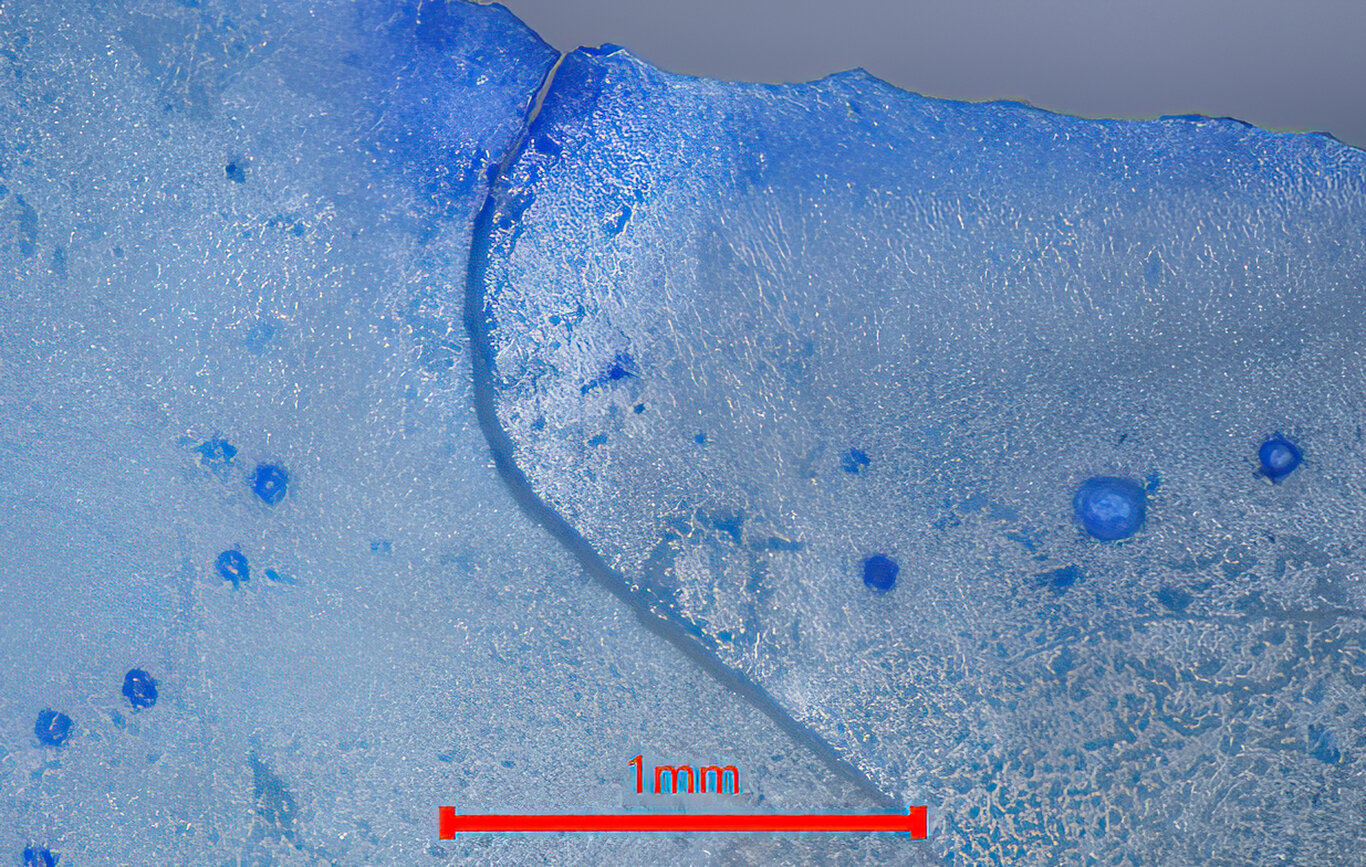 Premium restorations with bulk-fill composites | Ivoclar
