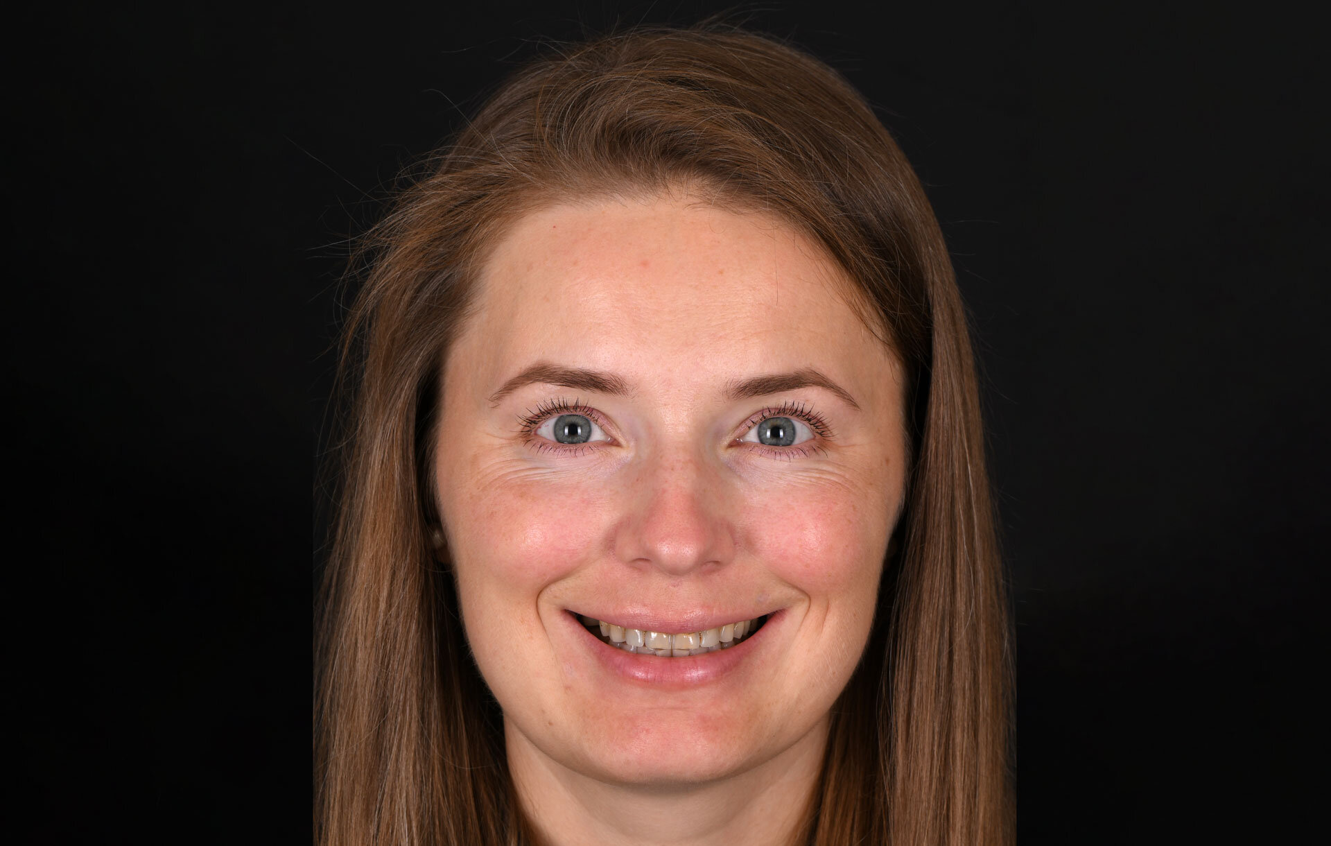 Efficient Esthetics with IPS e.max: Patient Case by Aiham Farah | Blog ...
