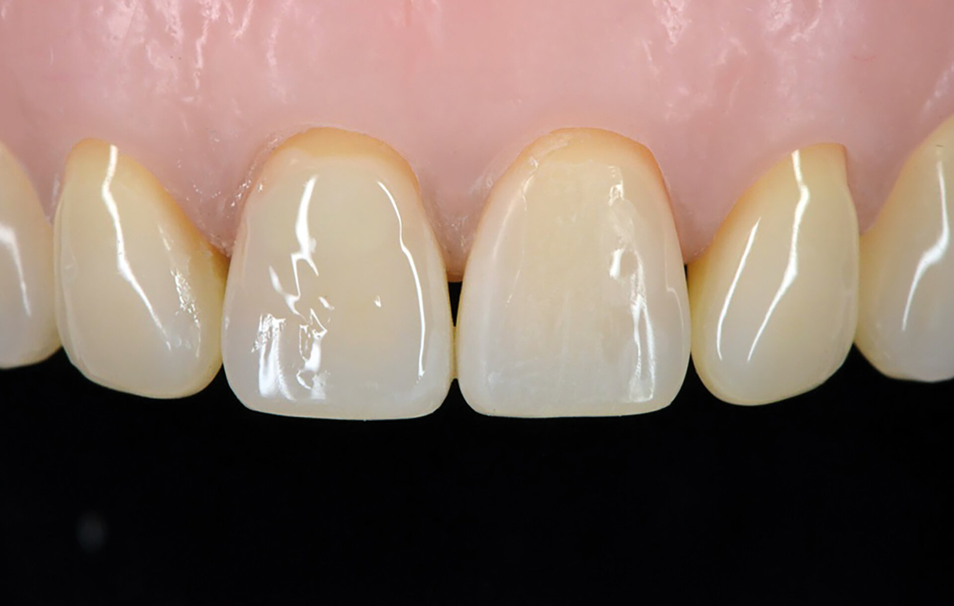 IPS Empress Direct Effect, Opaque and Color | Dental Composites | Ivoclar