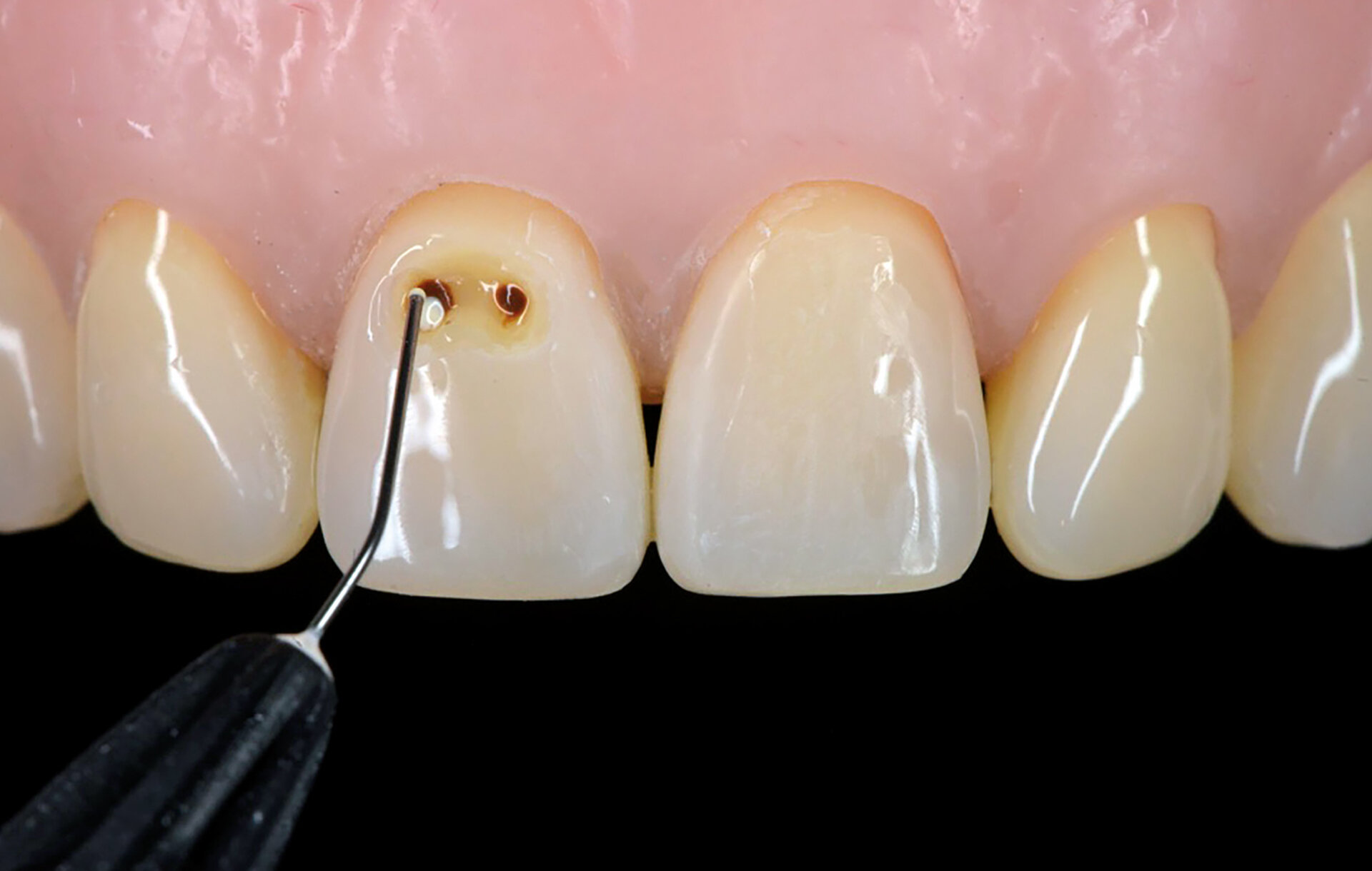 IPS Empress Direct Effect, Opaque and Color | Dental Composites | Ivoclar