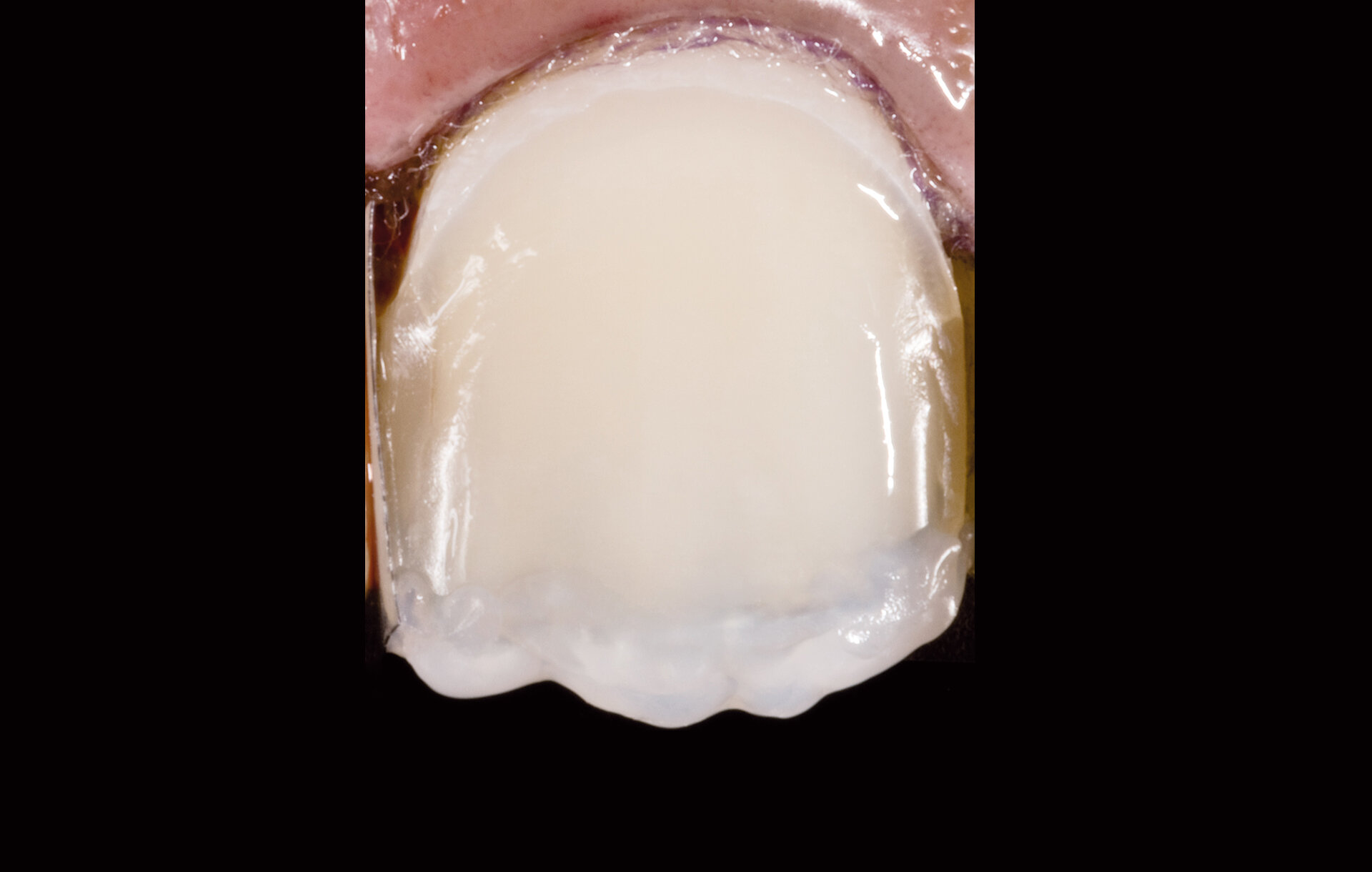 IPS Empress Direct Effect, Opaque and Color | Dental Composites | Ivoclar