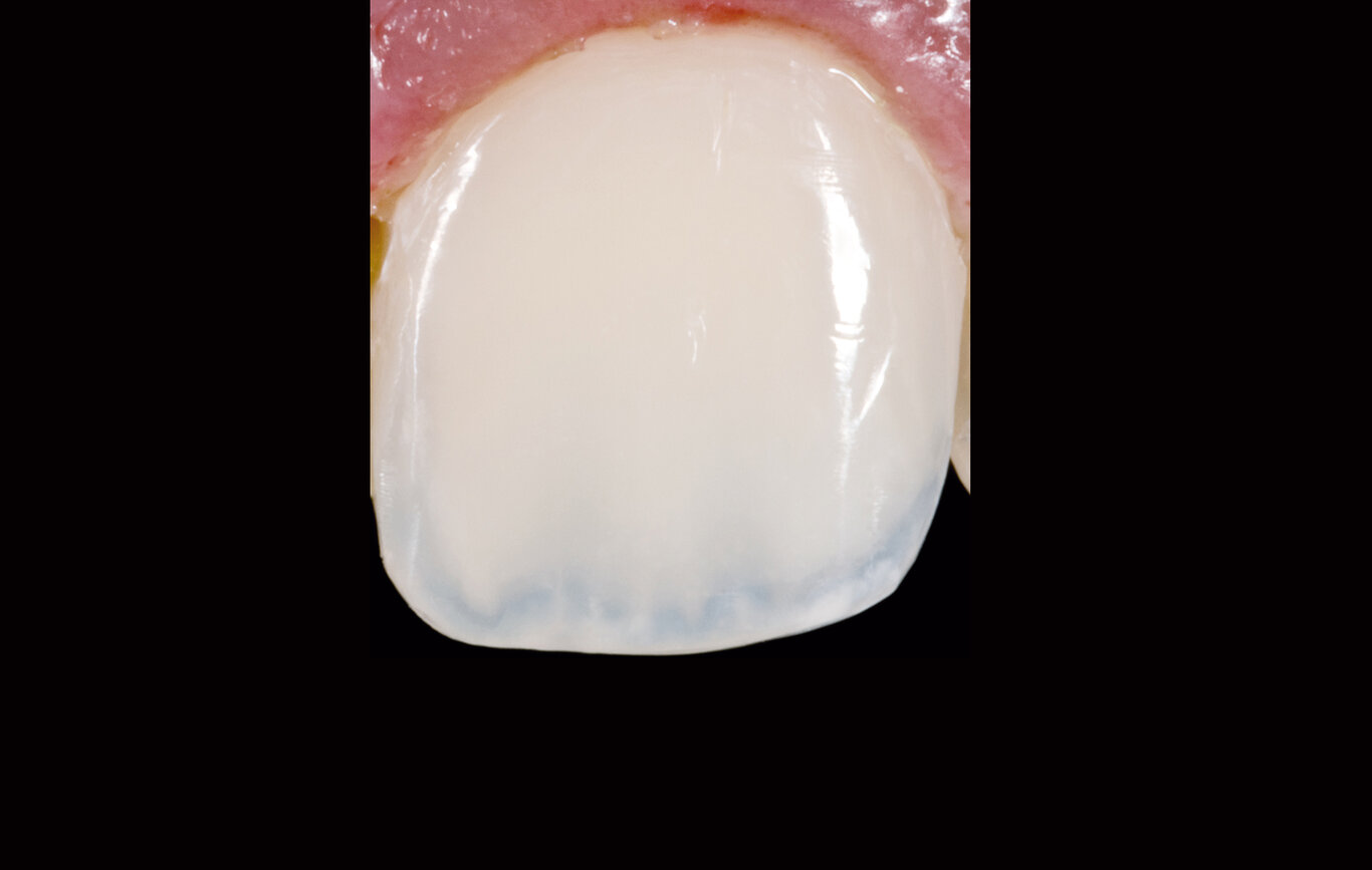 IPS Empress Direct Effect, Opaque and Color | Dental Composites | Ivoclar