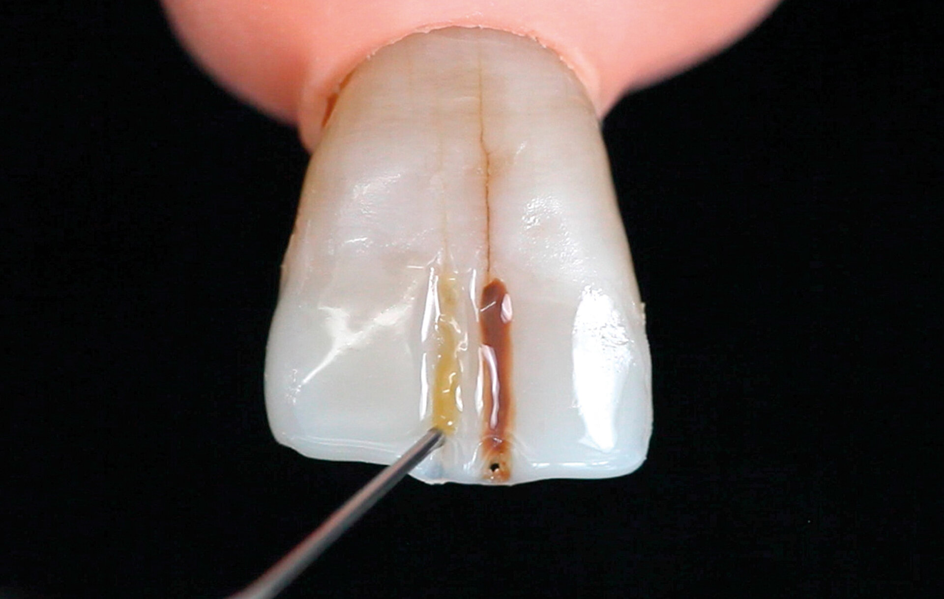 IPS Empress Direct Effect, Opaque and Color | Dental Composites | Ivoclar