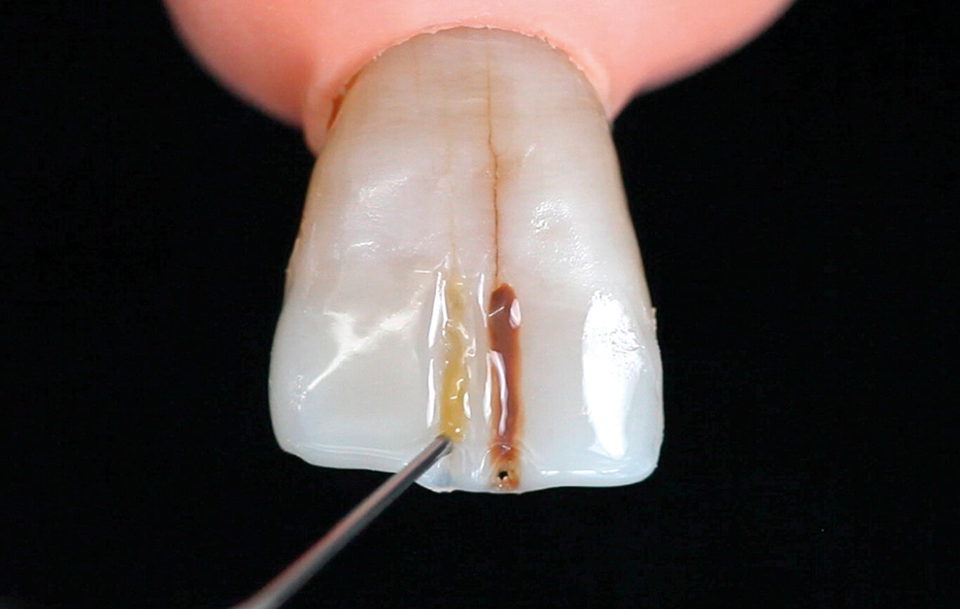 IPS Empress Direct Effect, Opaque and Color | Dental Composites | Ivoclar
