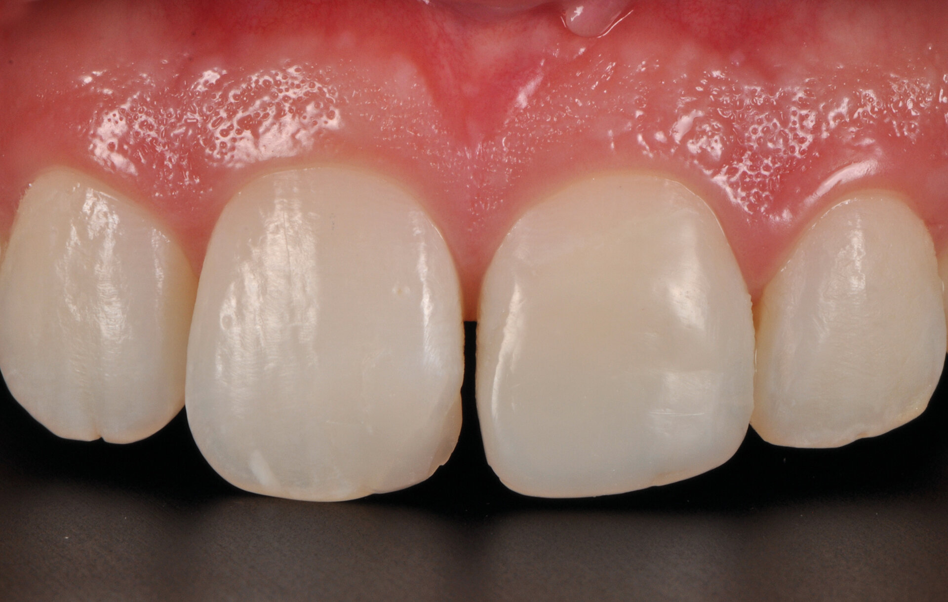 IPS Empress Direct | Dental Composites | Ivoclar