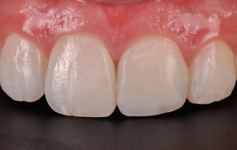 IPS Empress Direct | Dental Composites | Ivoclar USA