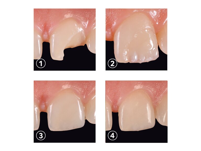 IPS Empress Direct | Dental Composites | Ivoclar USA
