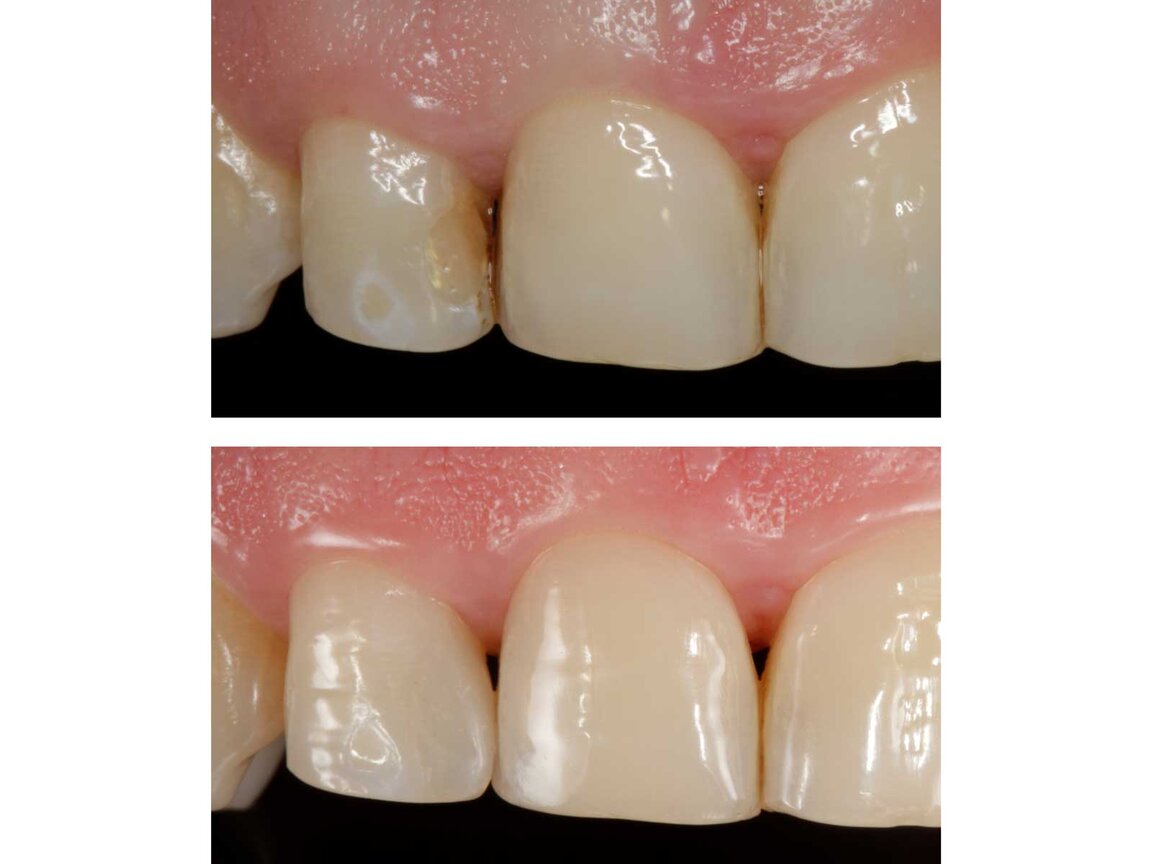 The Tetric Line | Dental Composites | Ivoclar USA