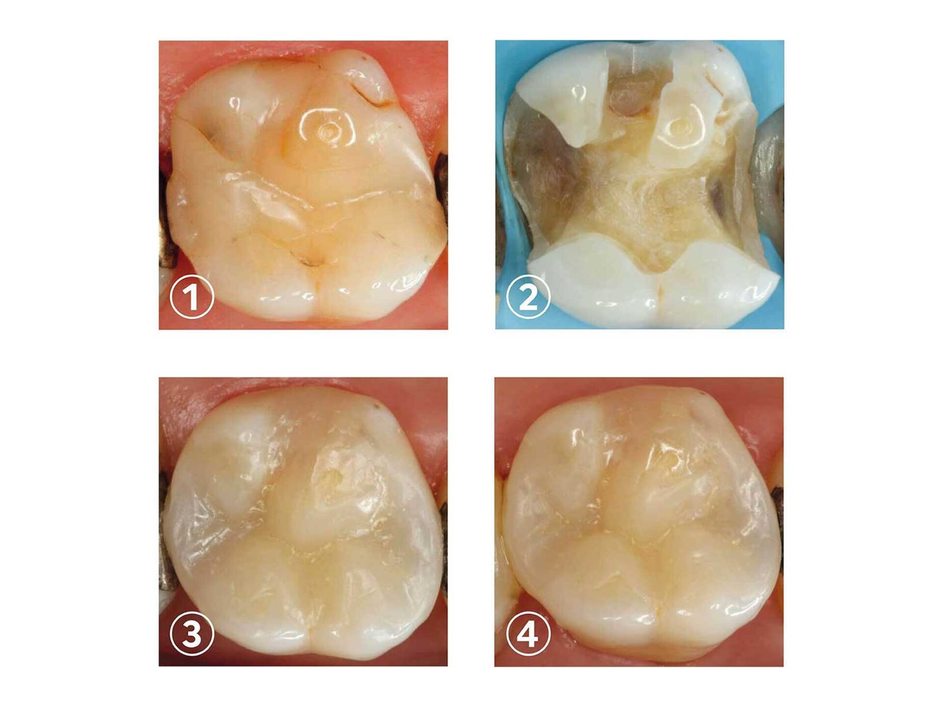 The Tetric Line | Dental Composites | Ivoclar USA