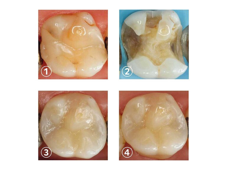 Tetric PowerFill | Dental Composites | Ivoclar USA