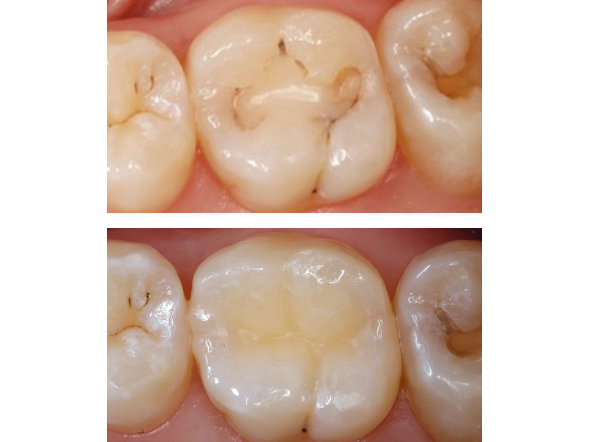 Tetric plus | Simplified universal composite | Ivoclar