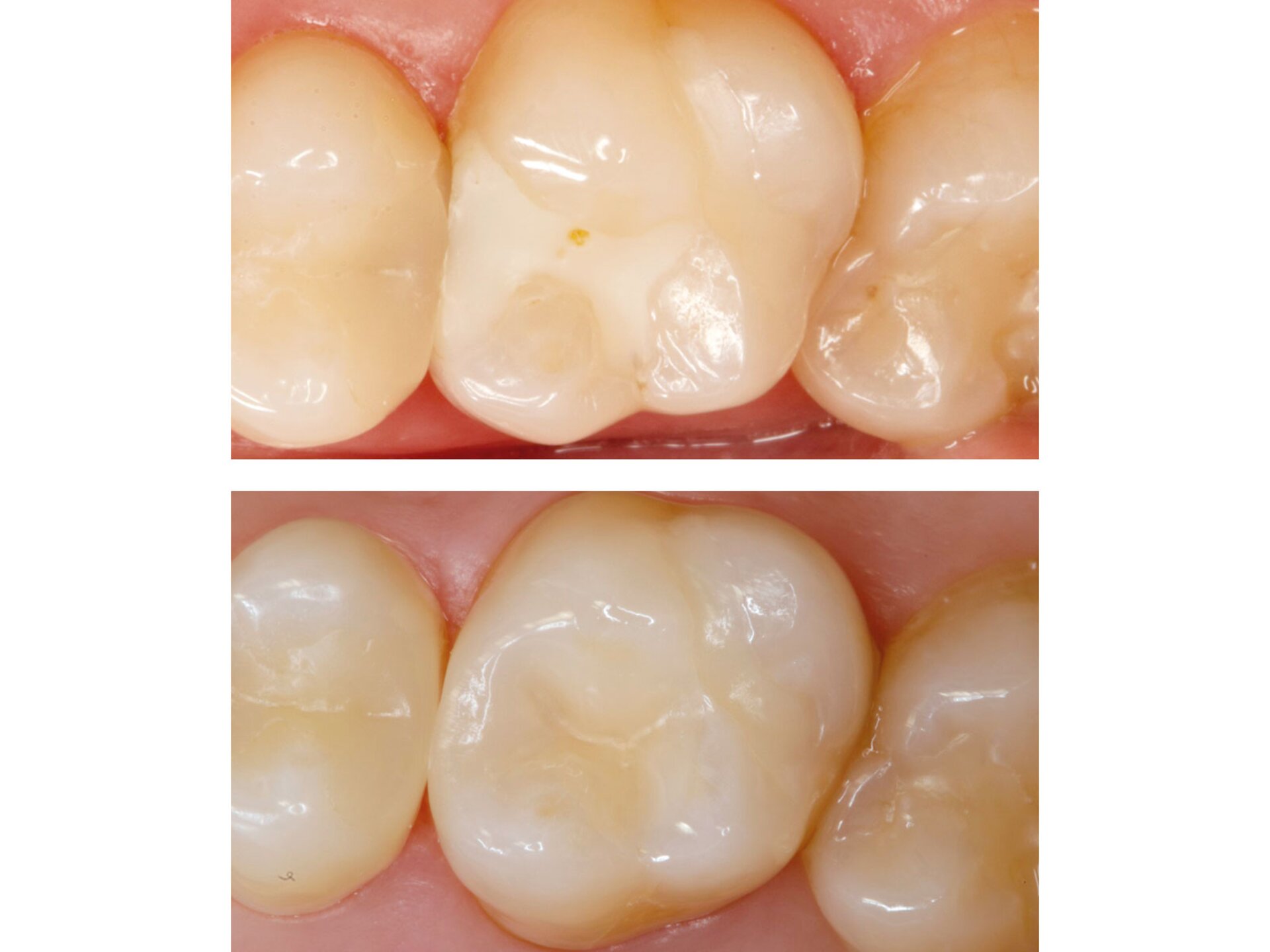 Tetric plus | Simplified universal composite | Ivoclar