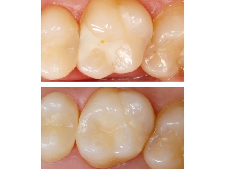 Tetric plus | Simplified universal composite | Ivoclar