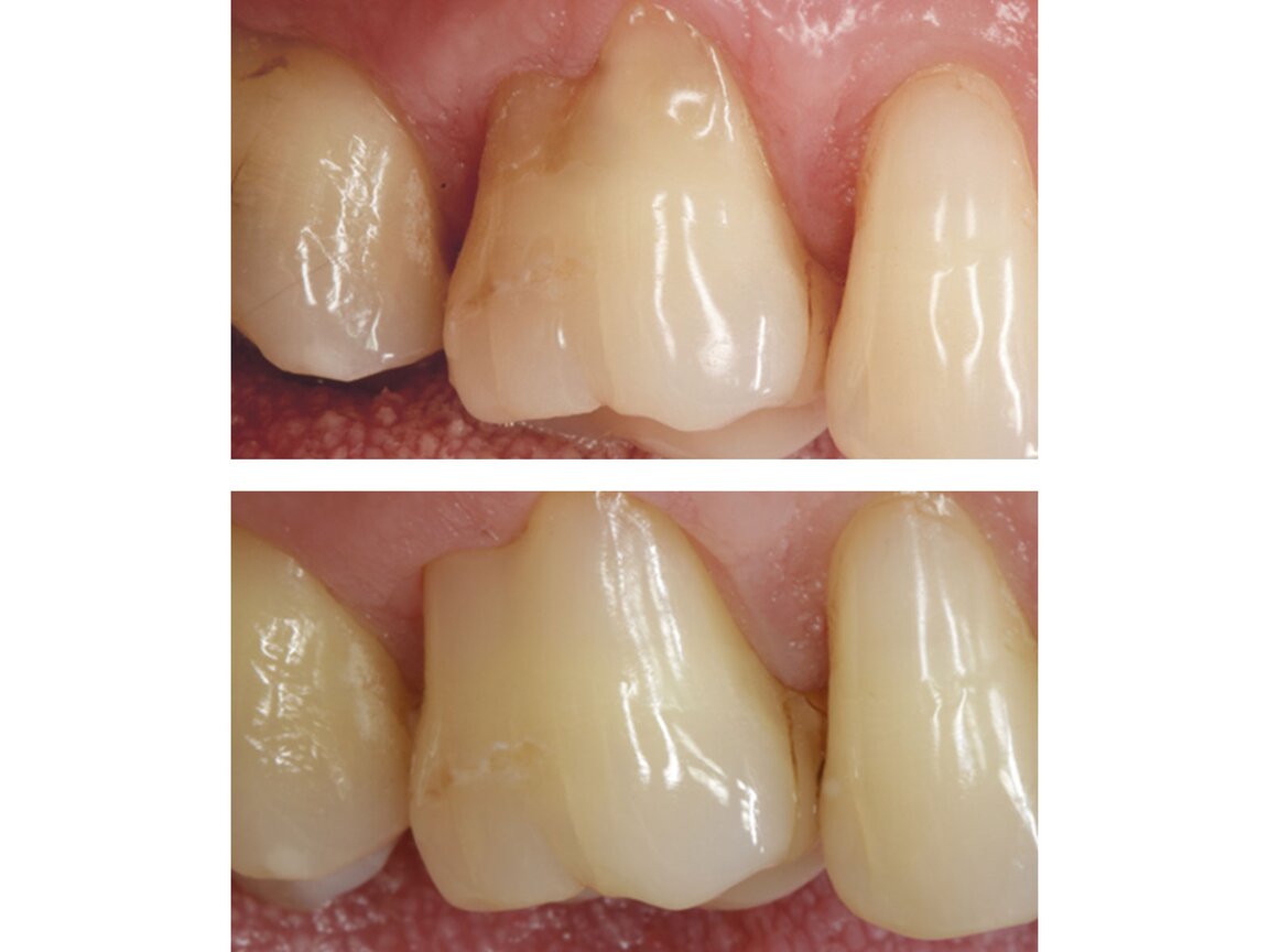 Tetric plus | Simplified universal composite | Ivoclar