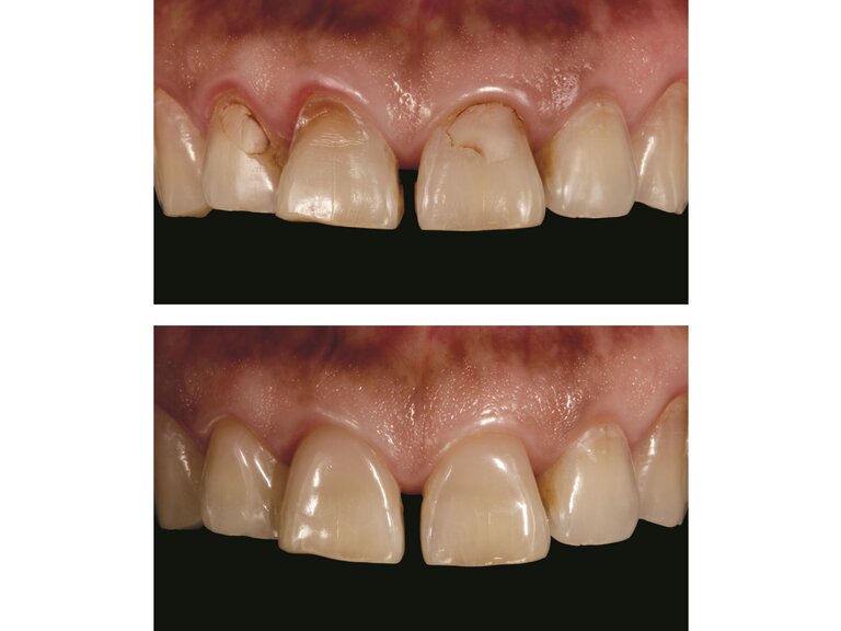 Tetric plus | Simplified universal composite | Ivoclar