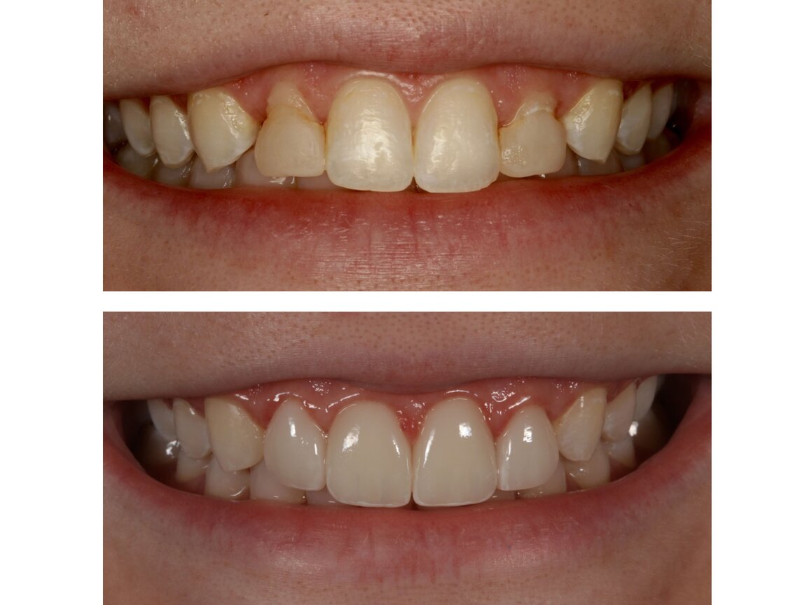 IPS e.max CAD | Lithium disilicate block for CAD/CAM | Ivoclar