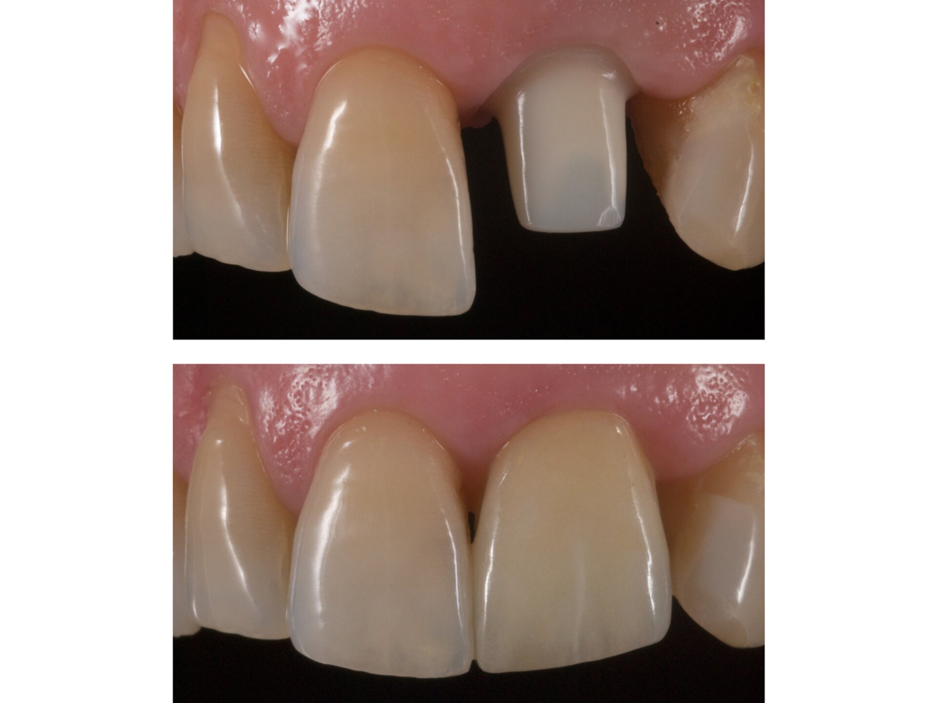 IPS e.max Press | Glass-ceramic Dental Restorations | Ivoclar USA