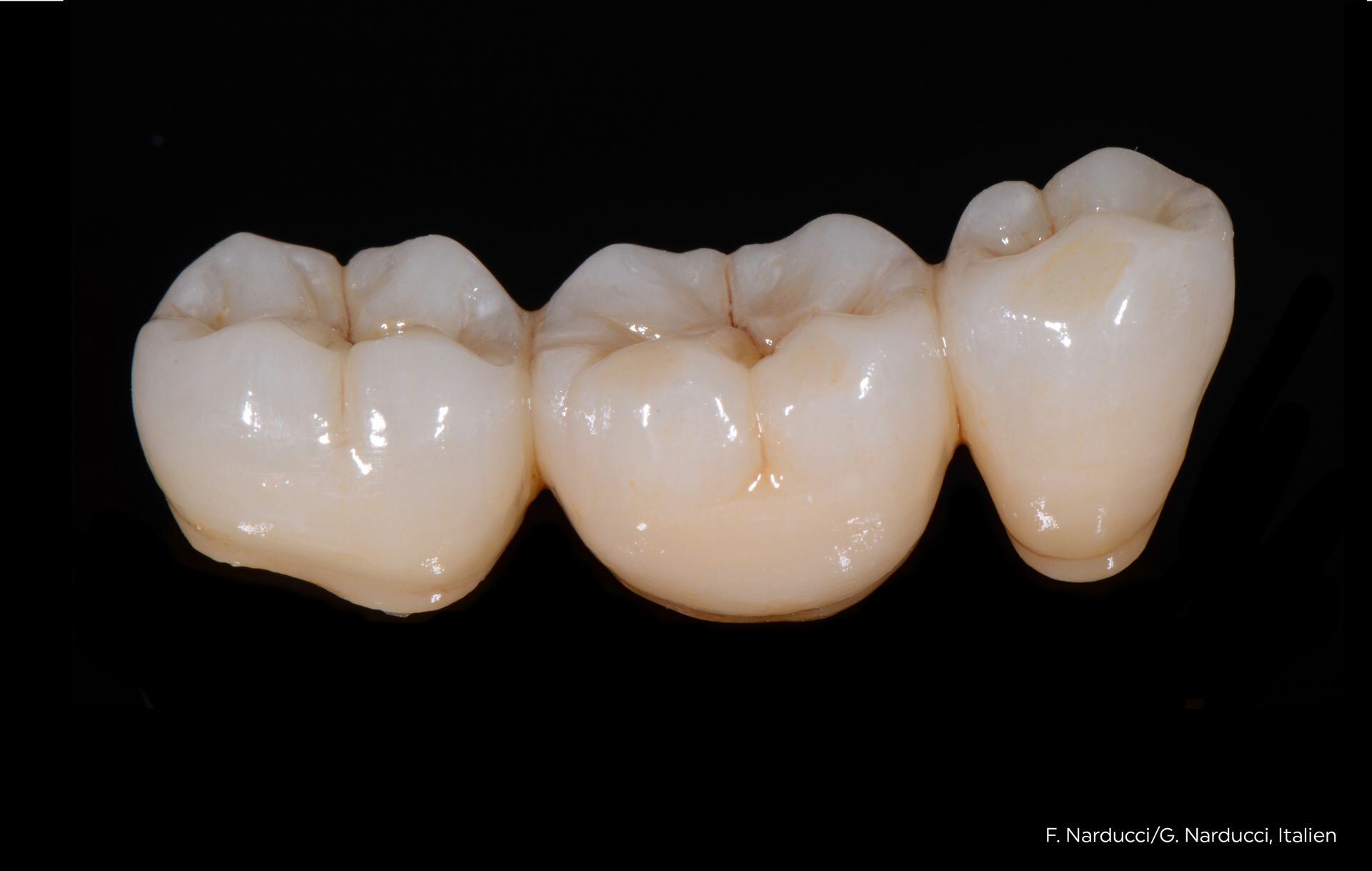 IPS e.max ZirCAD Prime | Zirconia Restorations | Ivoclar