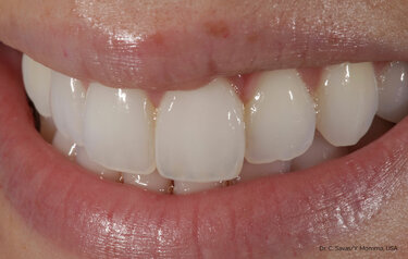 IPS e.max ZirCAD Prime | Zirconia Restorations | Ivoclar USA