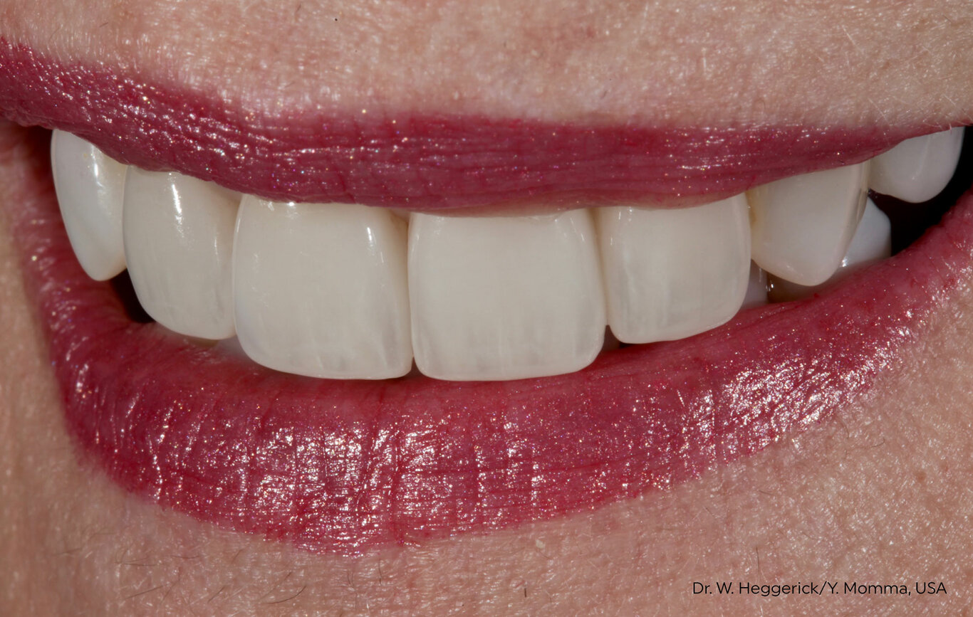 IPS e.max ZirCAD Prime | Zirconia Restorations | Ivoclar USA