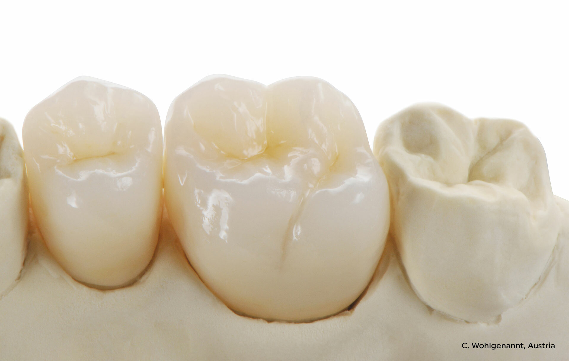 IPS e.max ZirCAD Prime | Zirconia Restorations | Ivoclar