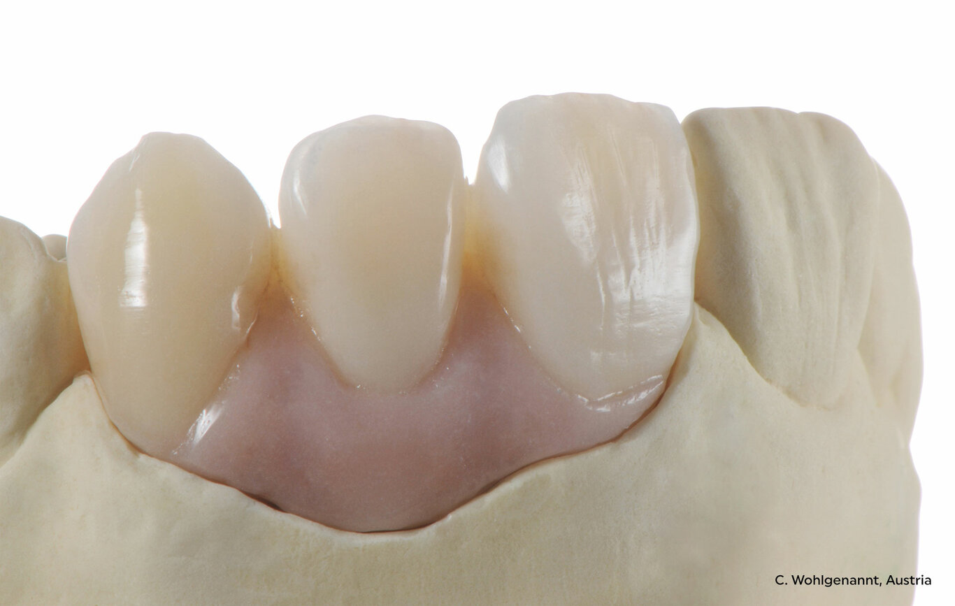 IPS e.max ZirCAD Prime | Zirconia Restorations | Ivoclar