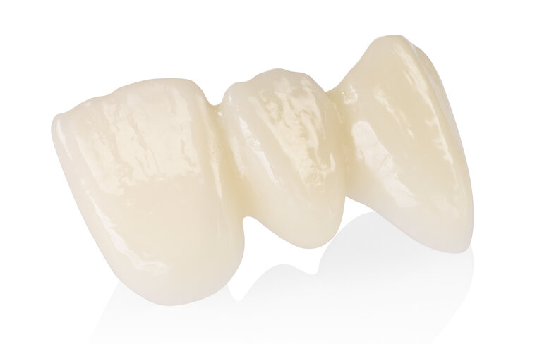 IPS e.max Press | Glass Ceramic Restorations | Ivoclar