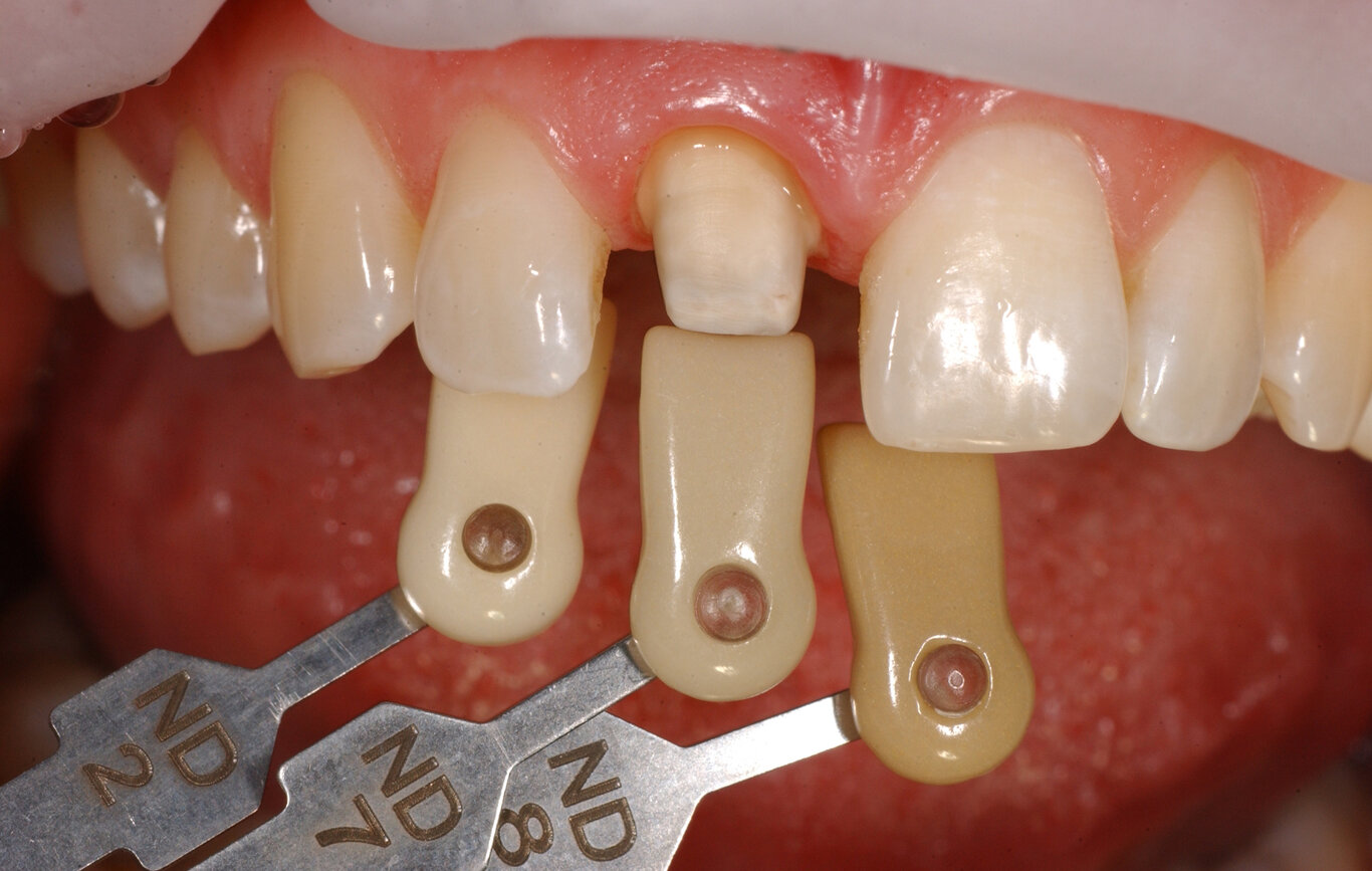 IPS e.max Press | Glass Ceramic Restorations | Ivoclar