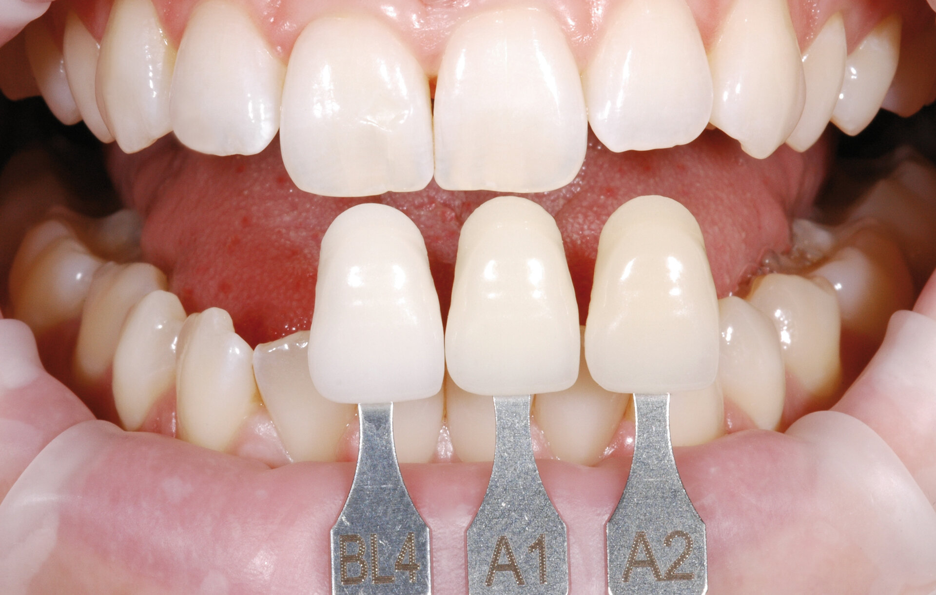 IPS e.max Press | Glass Ceramic Restorations | Ivoclar
