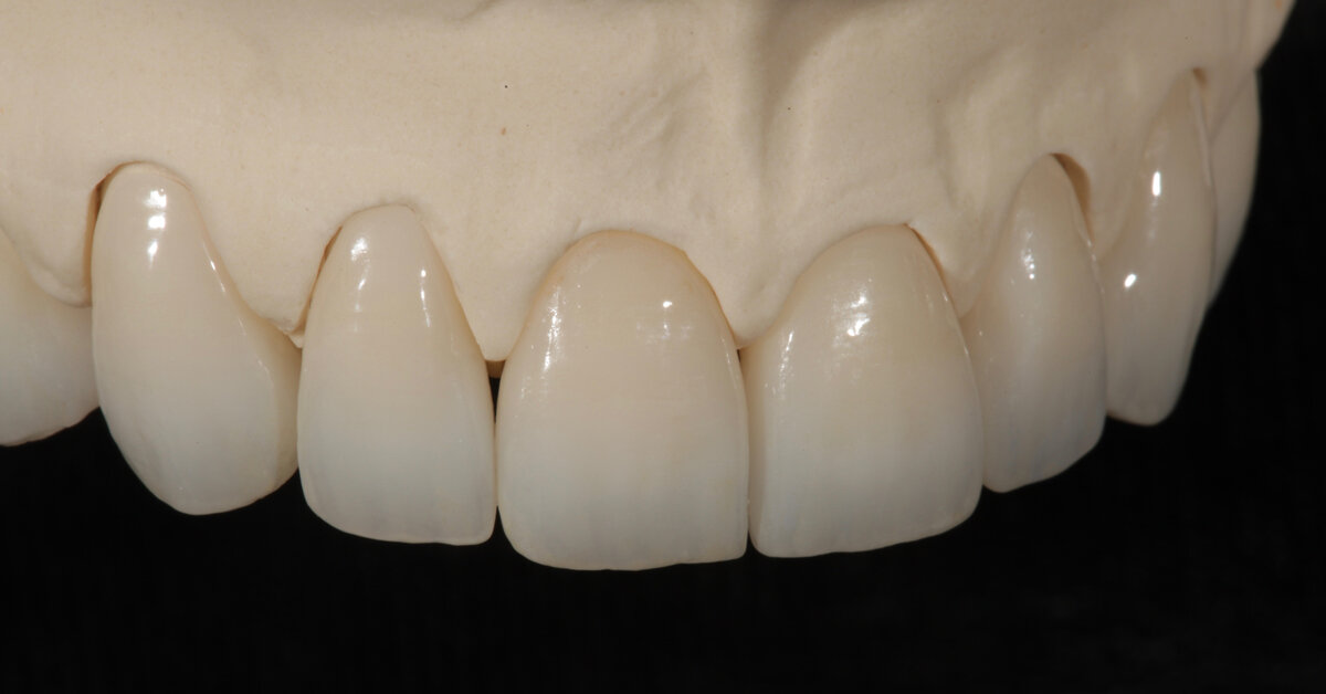 IPS Ivocolor : Ivoclar