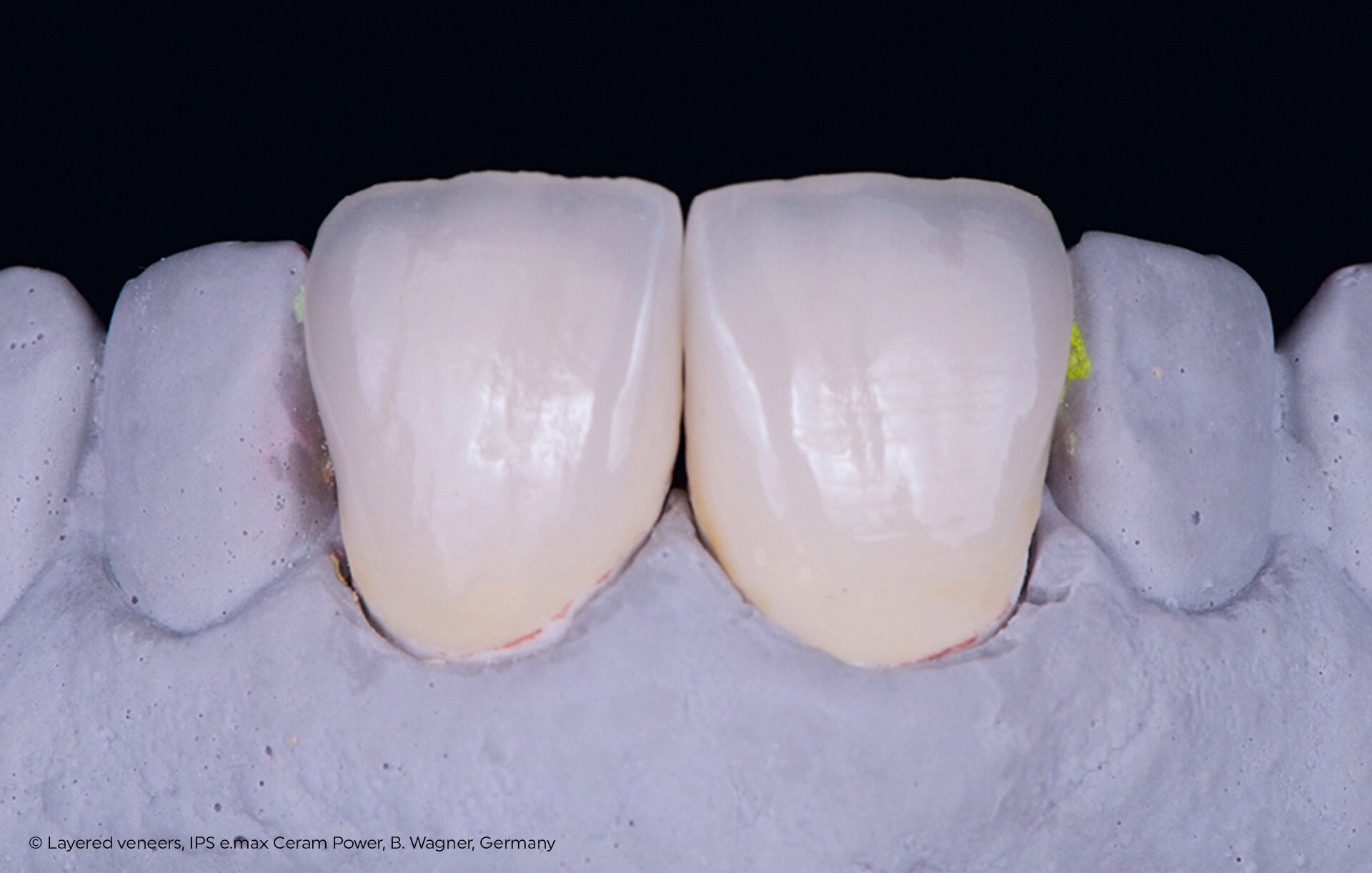 IPS e.max Ceram | Dental Veneering Material | Ivoclar