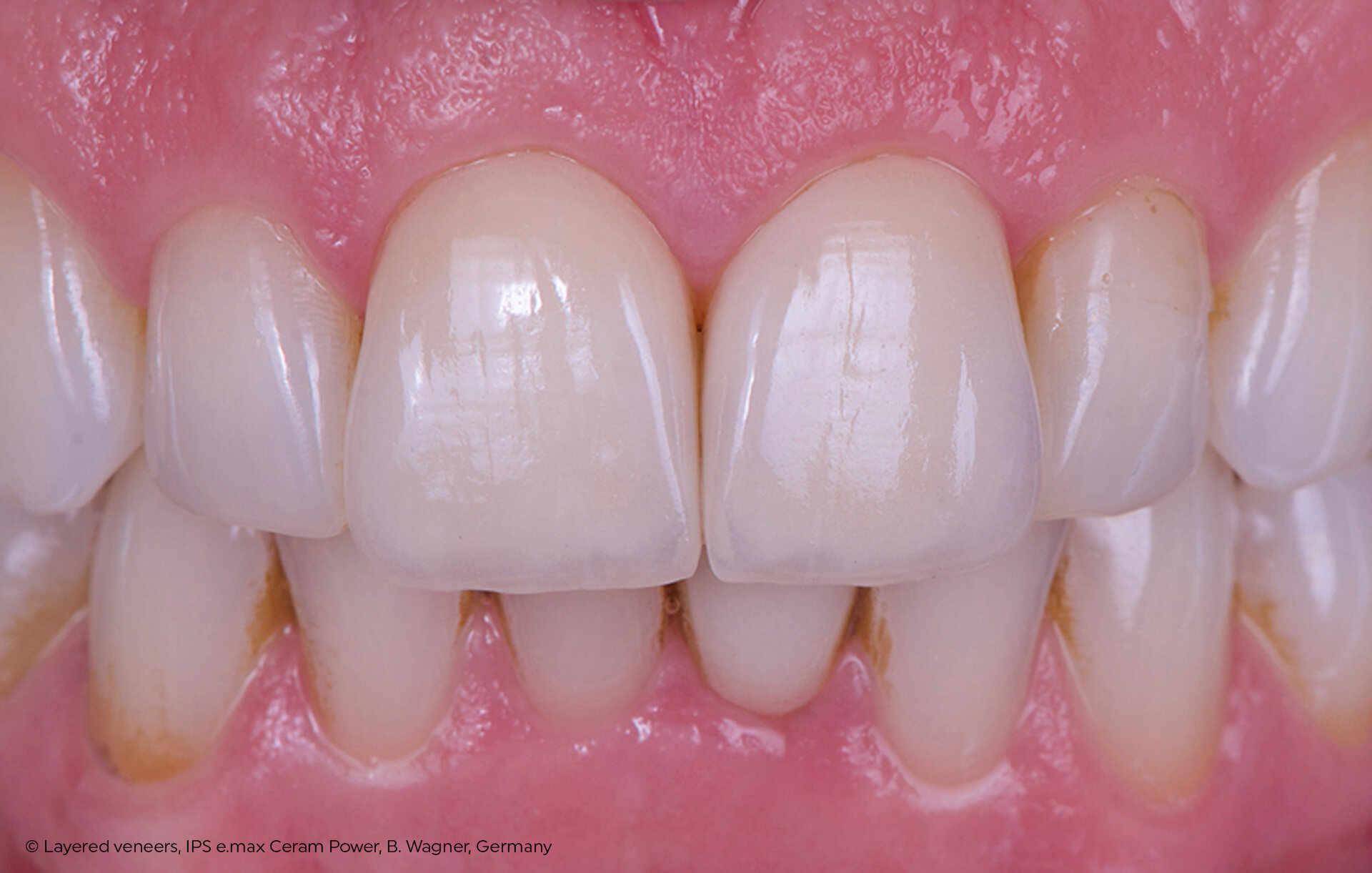 IPS e.max Ceram | Dental Veneering Material | Ivoclar