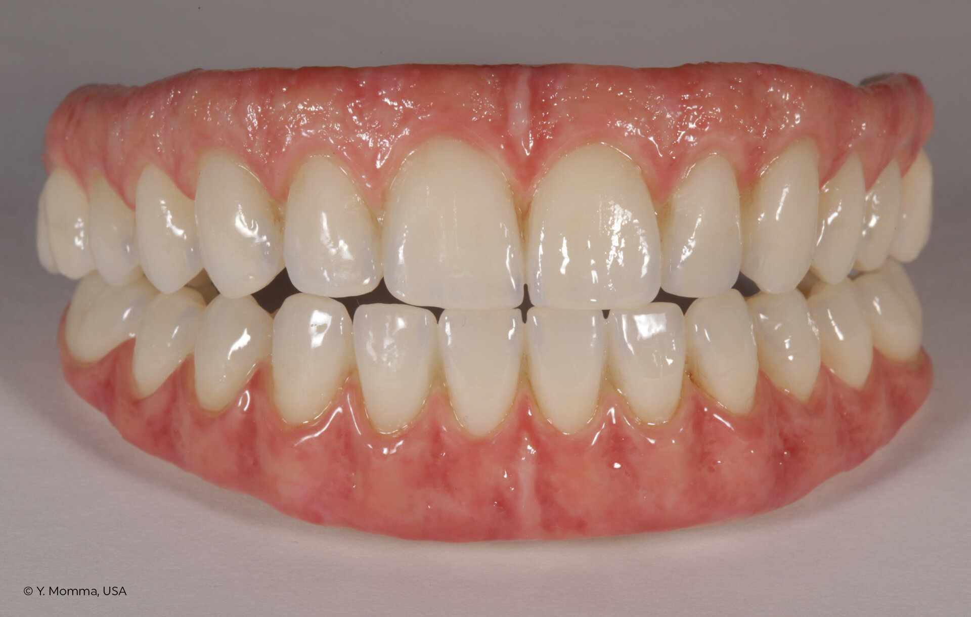IPS e.max Ceram | Dental Veneering Material | Ivoclar