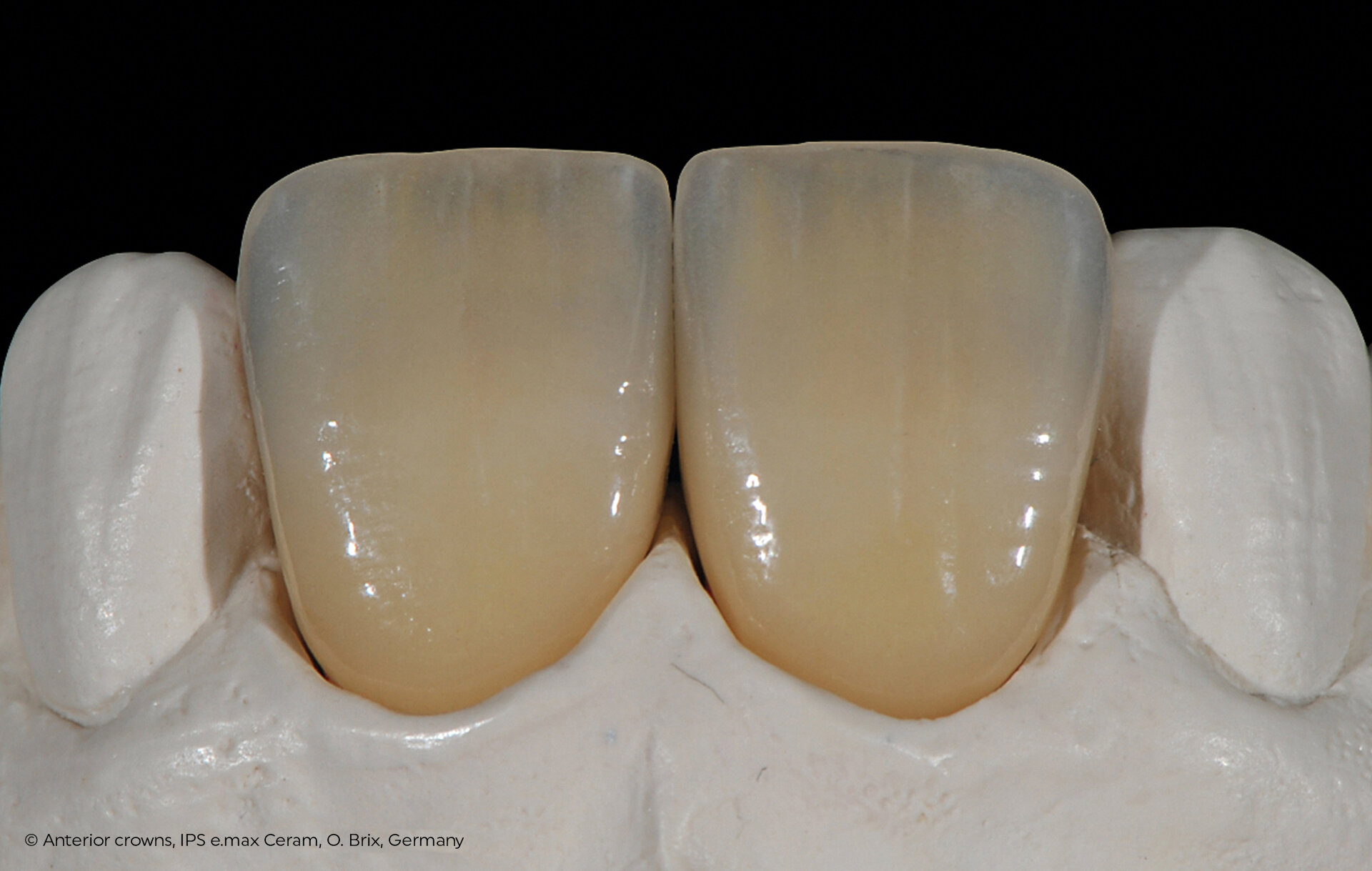 IPS e.max Ceram | Dental Veneering Material | Ivoclar