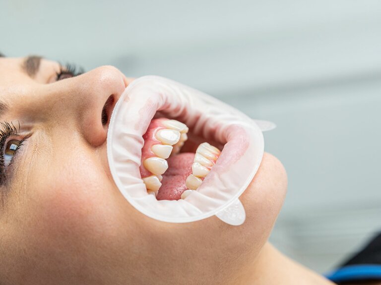 Fixed Prosthetics | Dental Workflows | Ivoclar USA