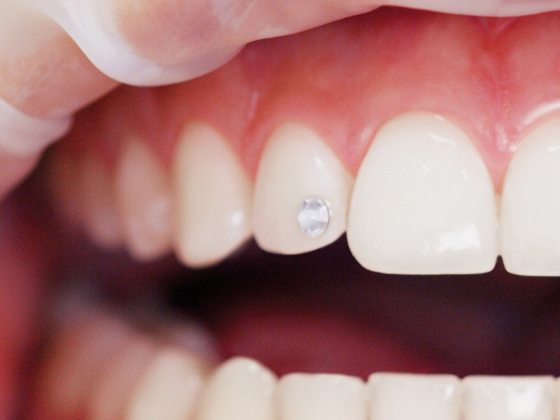 Professional Tooth Jewels | Dental Workflows | Ivoclar USA