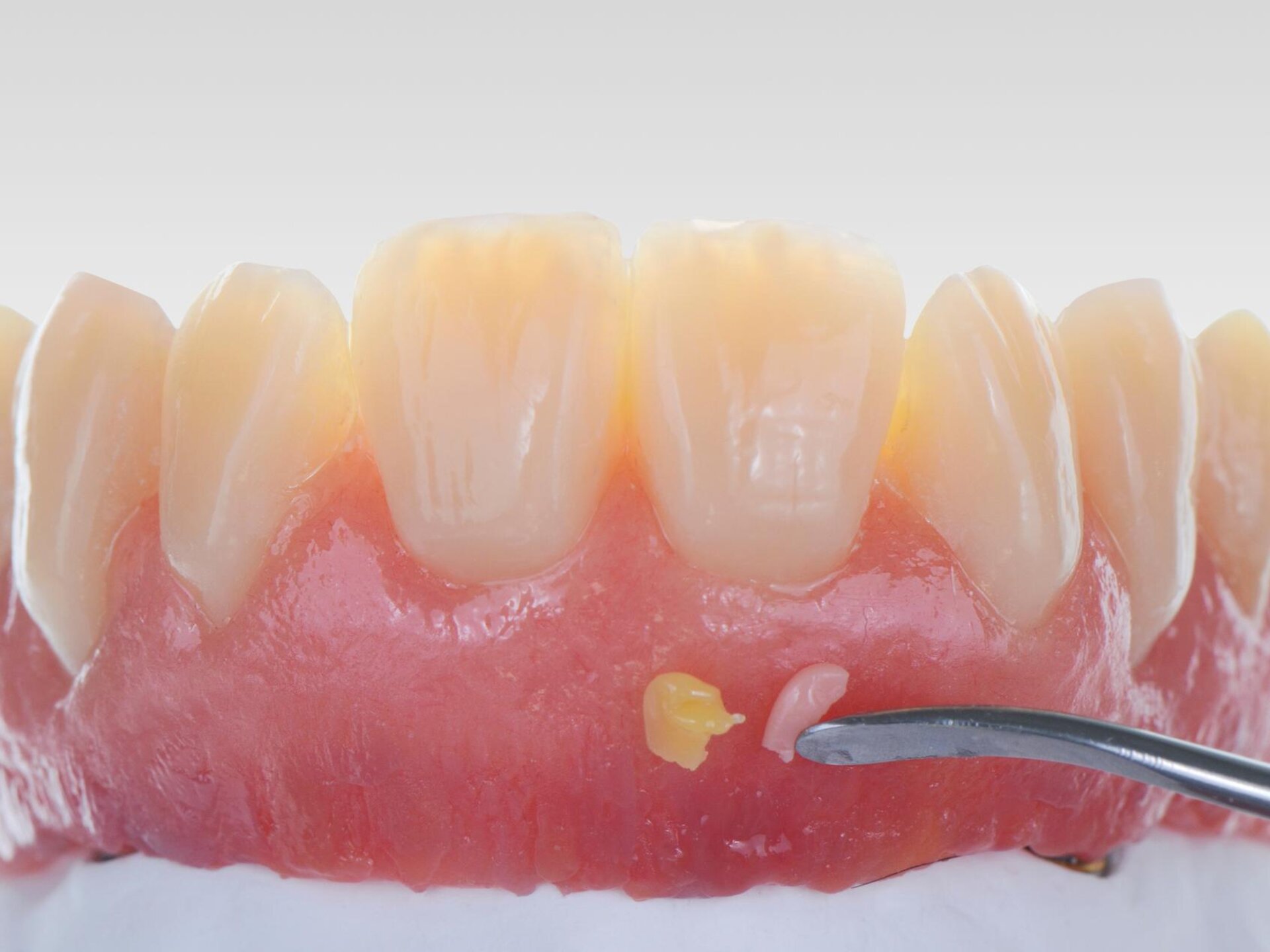 Removable Prosthetics Conventional | Dental Workflows | Ivoclar