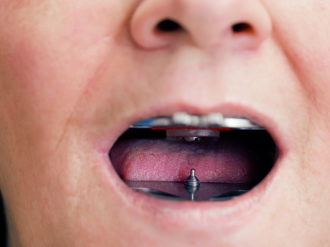 Removable Dental Prosthetics | Dental Workflows | Ivoclar USA