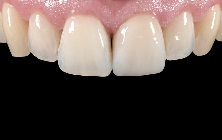 Adhesive cementation of veneers | Blog | Ivoclar
