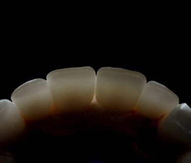 The Staining Technique: All-Ceramic Restorations | Ivoclar Canada