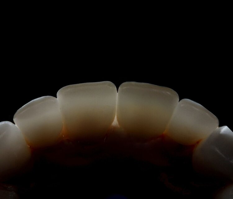 The Staining Technique: All-Ceramic Restorations | Ivoclar AU