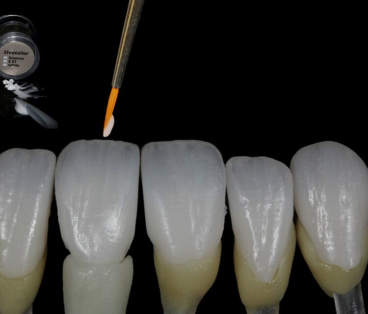 Pleasing esthetics – can the staining technique do it all?