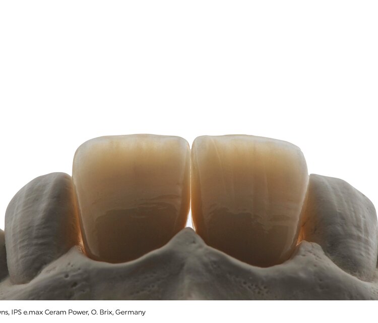 IPS e.max Ceram | Dental Veneering Material | Ivoclar