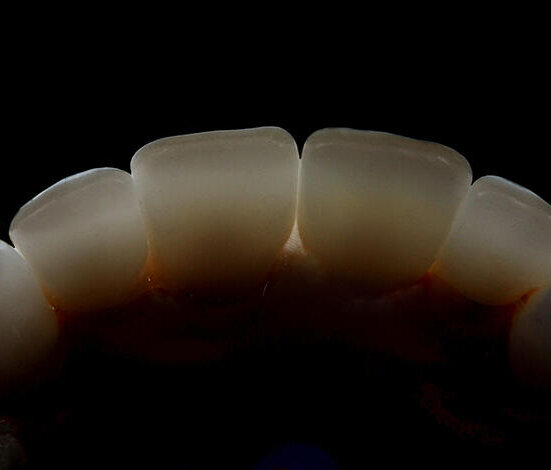 The Staining Technique: All-Ceramic Restorations | Blog | Ivoclar USA