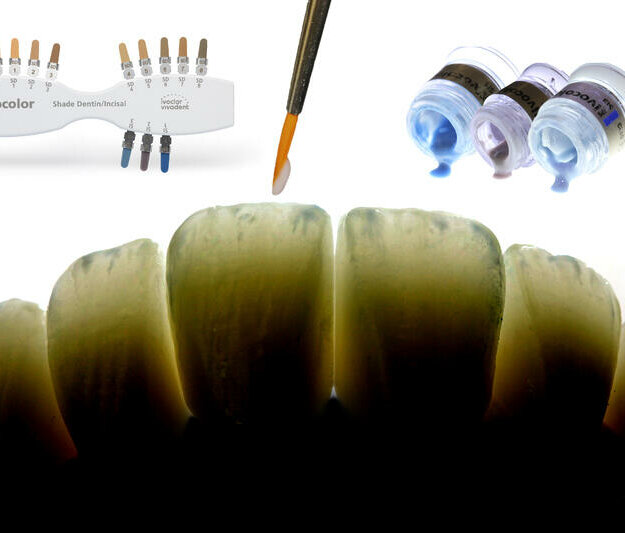 Pleasing esthetics – can the staining technique do it all?