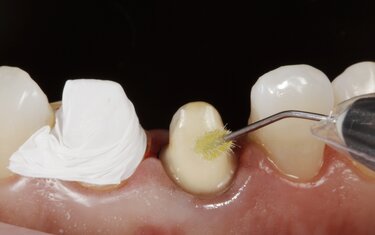 Click. Bond. Done: Streamline your bonding protocol with a real all-in ...