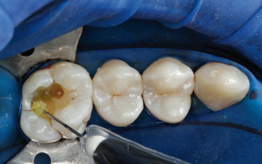 Click. Bond. Done: Streamline your bonding protocol with a real all-in ...