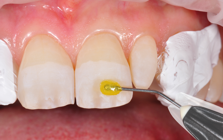 Click. Bond. Done: Streamline your bonding protocol with a real all-in ...