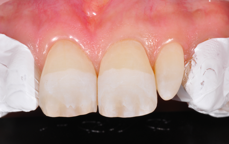 Click. Bond. Done: Streamline your bonding protocol with a real all-in ...