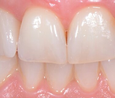 Highly Esthetic Zirconia Dental Restorations | Ivoclar Canada